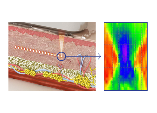 ULTRAFORMER lll - CLASSYS