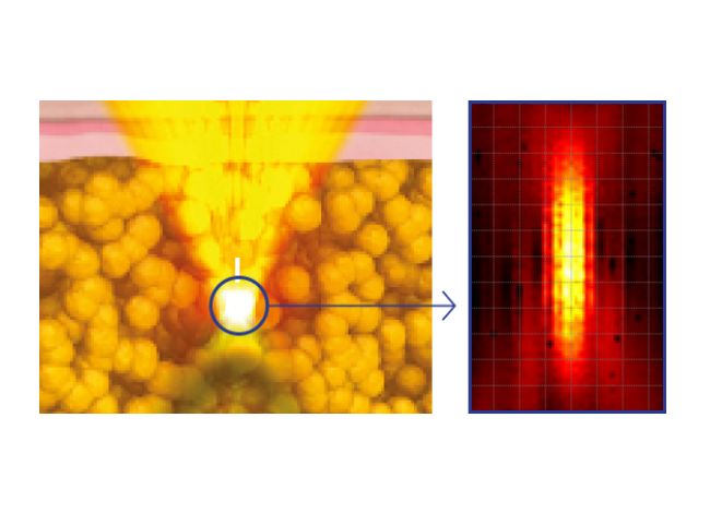 ULTRAFORMER lll - CLASSYS