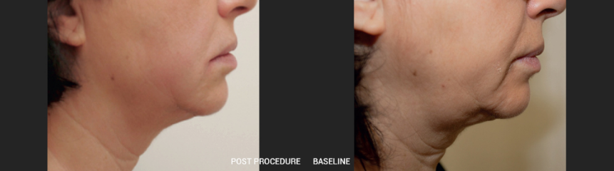 ULTRAFORMER lll - CLASSYS