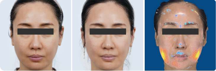 ULTRAFORMER MPT - CLASSYS