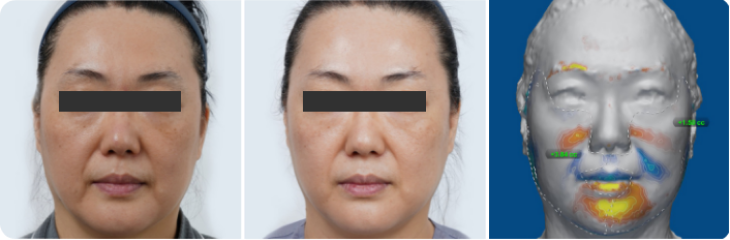 ULTRAFORMER MPT - CLASSYS