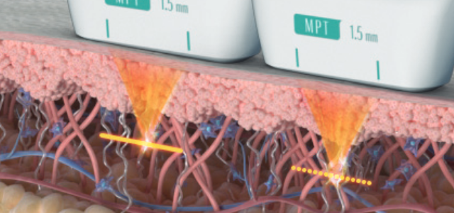 ULTRAFORMER MPT - CLASSYS