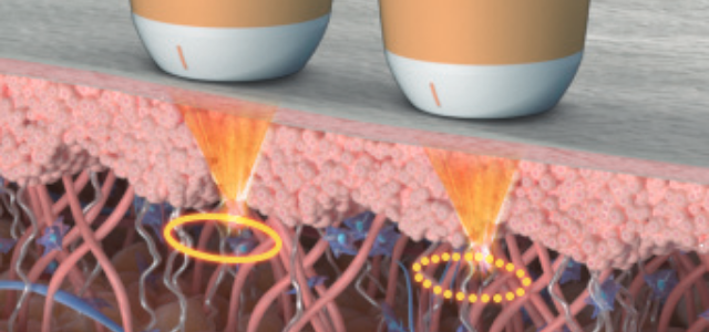 ULTRAFORMER MPT - CLASSYS