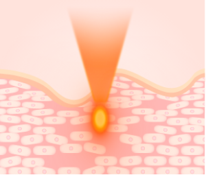 ULTRAFORMER lll - CLASSYS